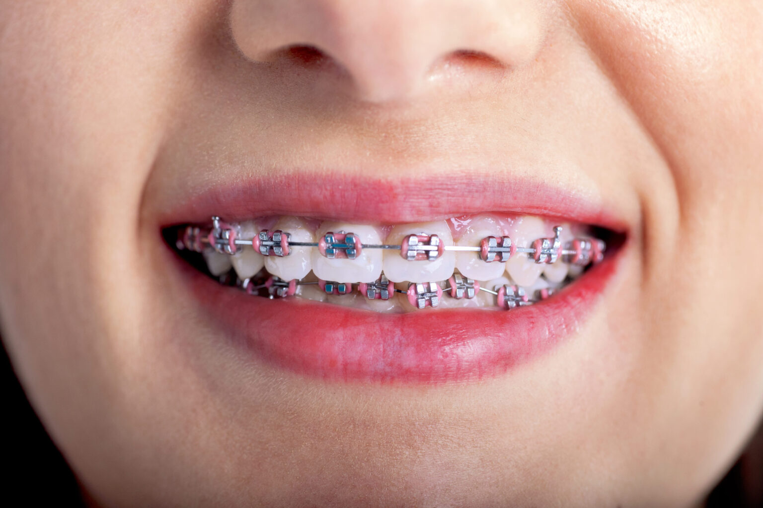Dental Braces: Types, Cost & What to Expect - dentalis.ph
